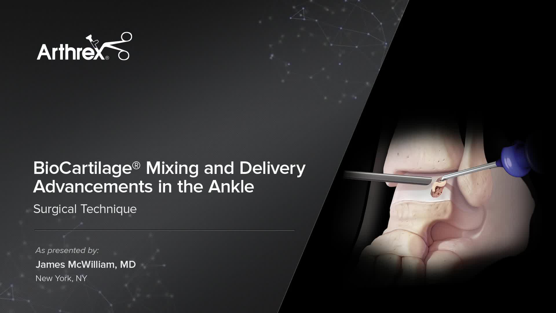 Arthrex - BioCartilage® Mixing and Delivery Advancements in the Ankle