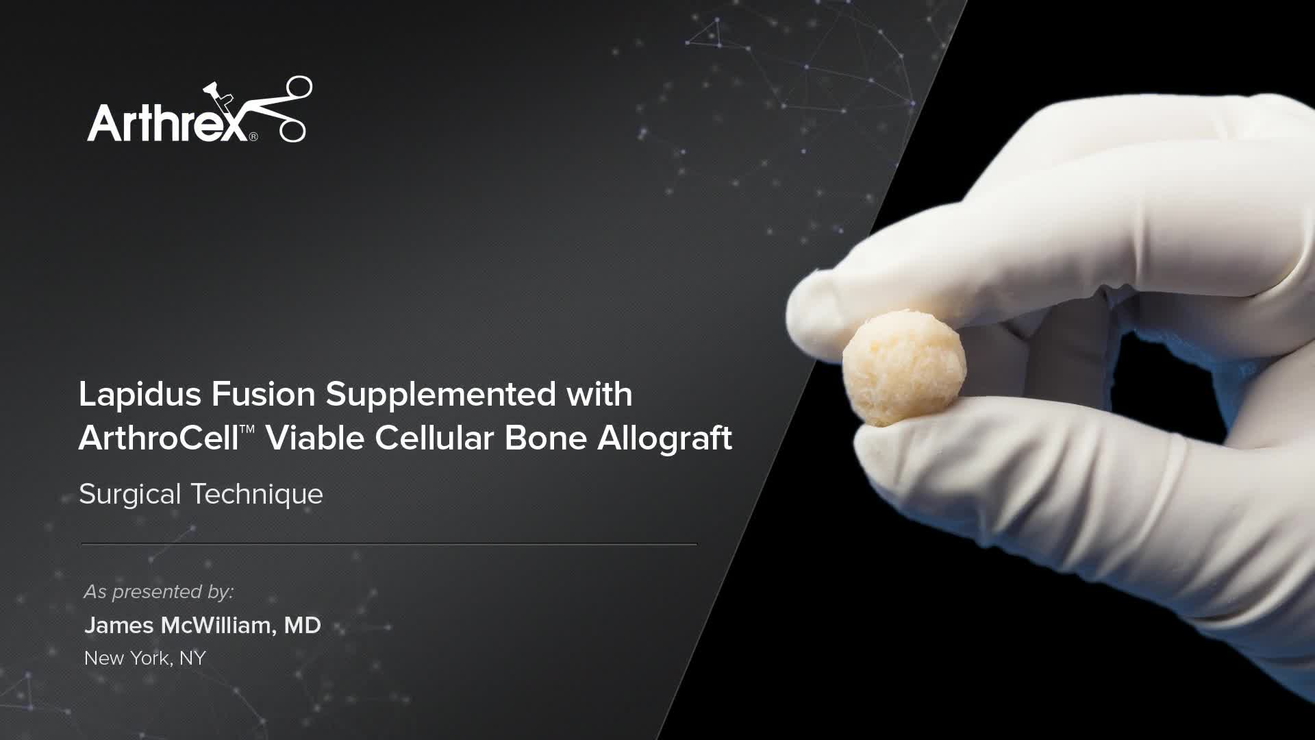 Arthrex - Lapidus Fusion Supplemented with ArthroCell™ Viable Cellular ...