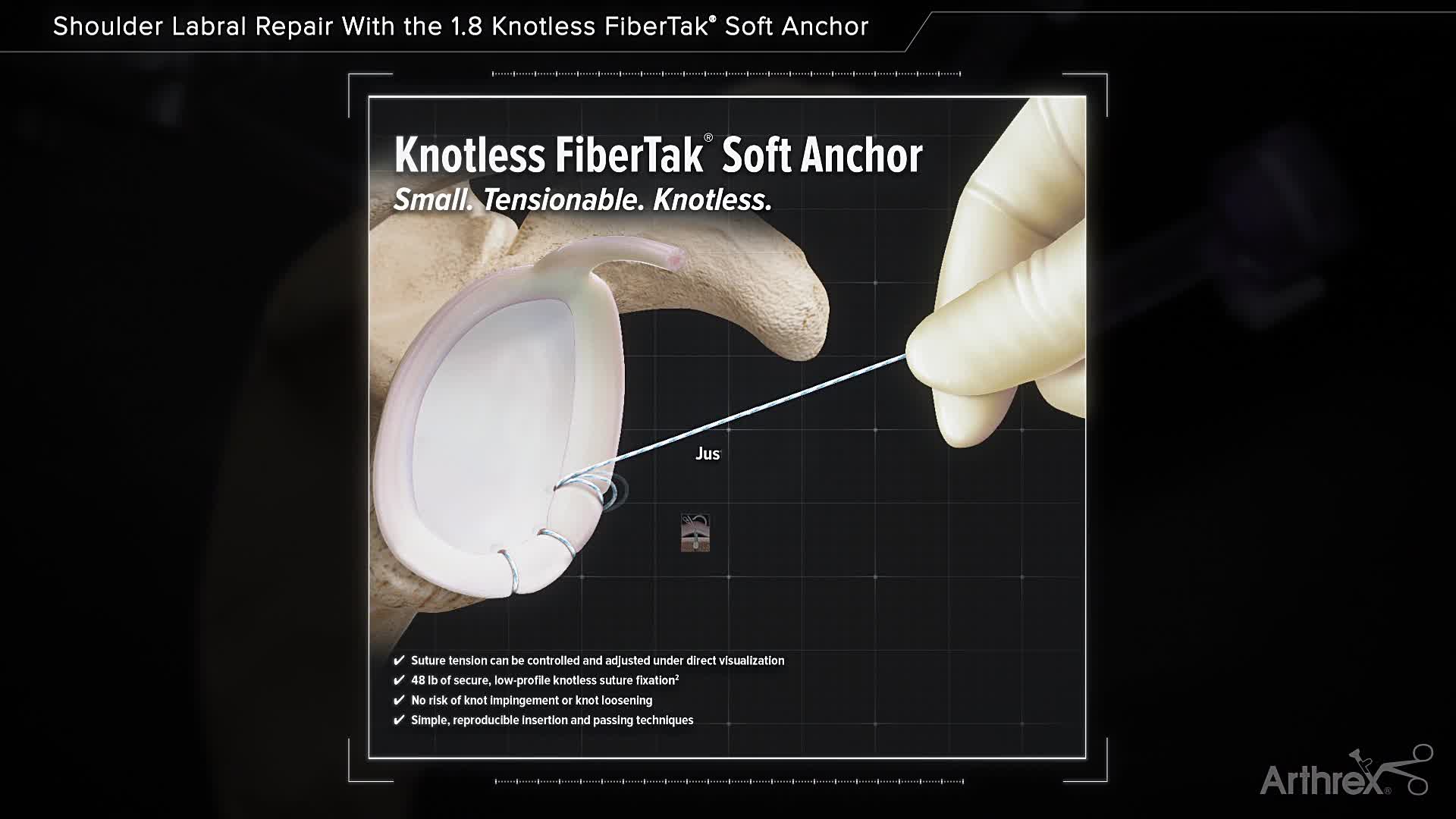 Arthrex - Shoulder Labral Repair With the 1.8 Knotless FiberTak® Soft ...