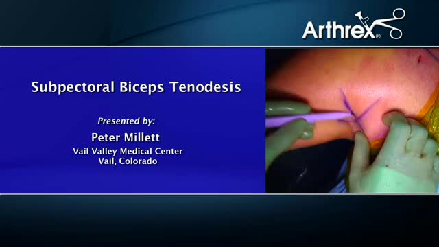 Arthrex - Subpectoral Biceps Tenodesis
