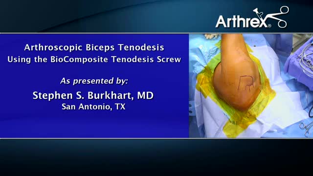 Arthrex - Arthroscopic Biceps Tenodesis Using the BioComposite ...