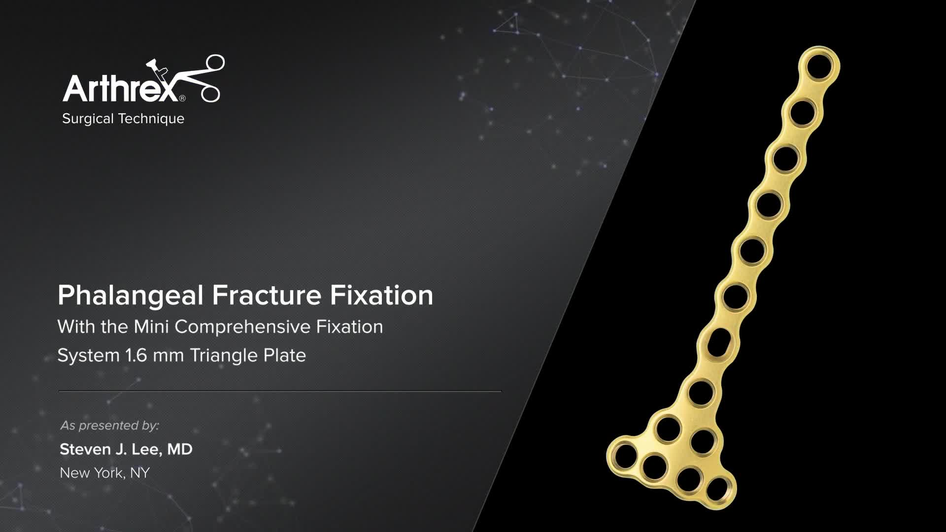 Arthrex - Phalangeal Fracture Fixation With the Mini Comprehensive ...