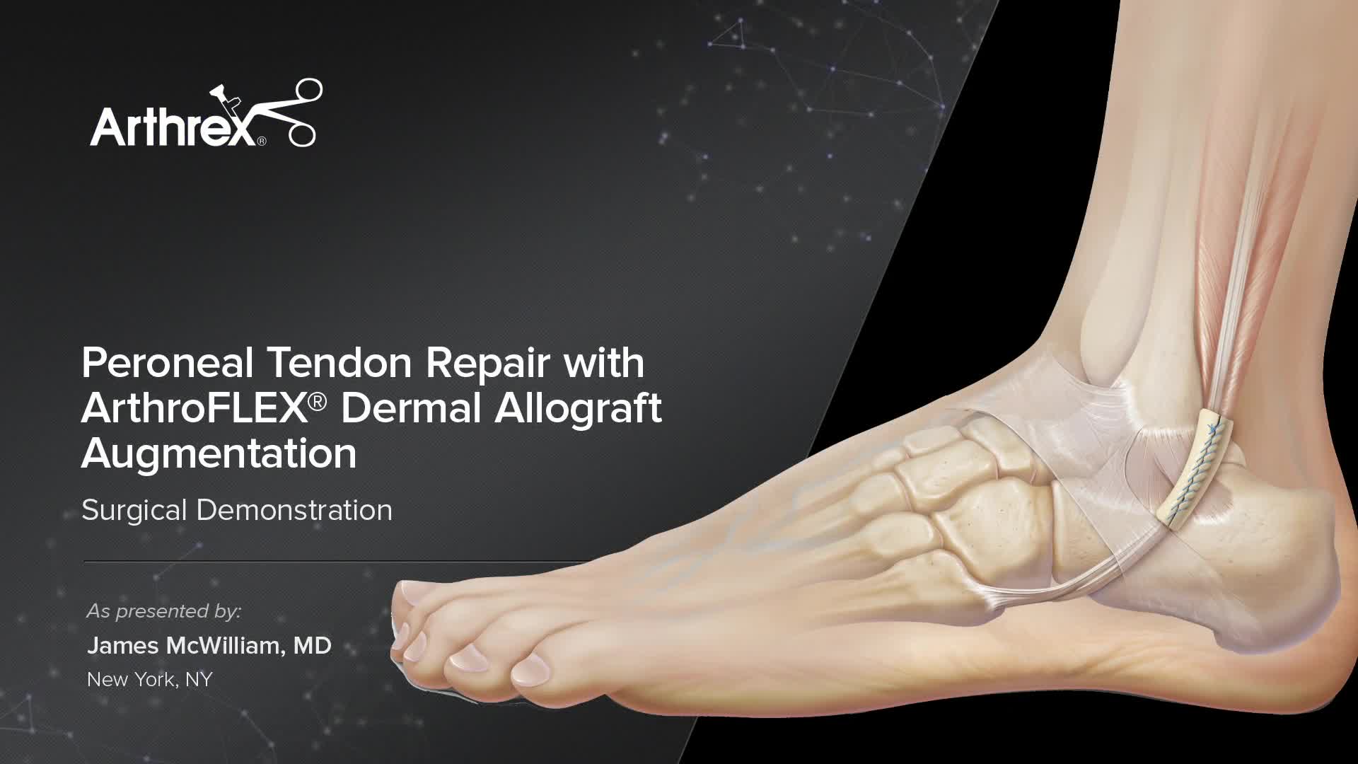 Arthrex - Peroneal Tendon Repair with ArthroFLEX® Dermal Allograft ...