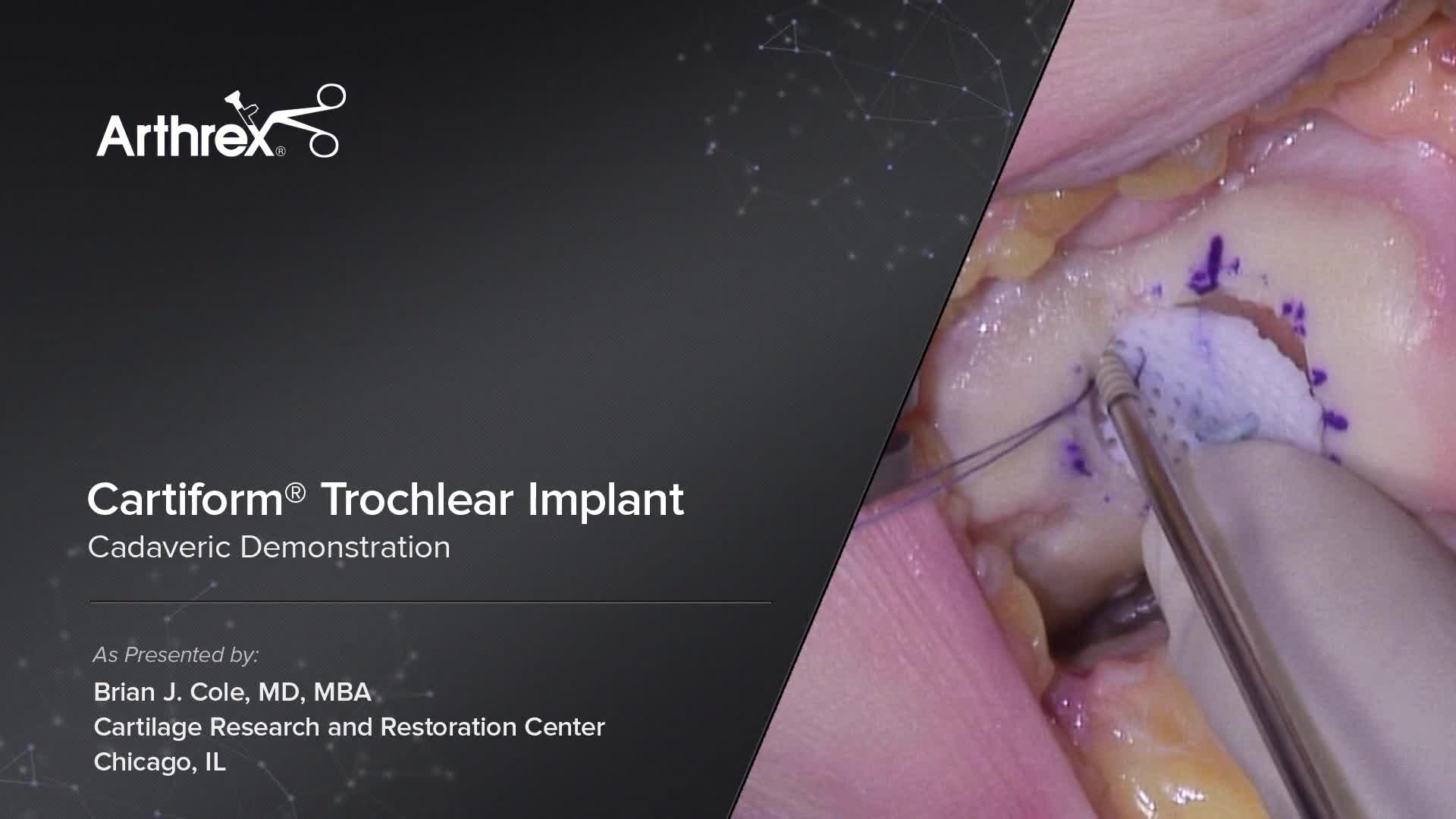 Arthrex - Cartiform® Trochlear Implant Cadaveric Demonstration