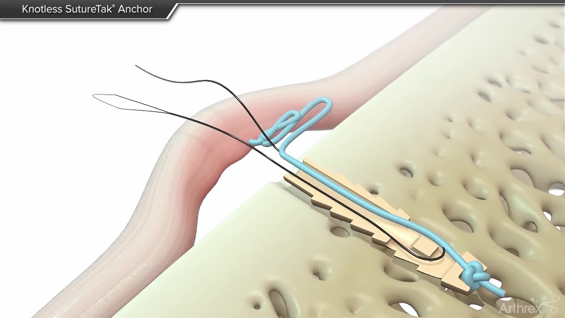 Arthrex - Knotless SutureTak® Anchor