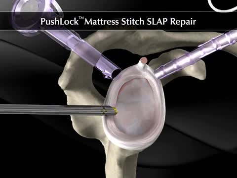 Arthrex - PushLock® Mattress Stitch SLAP Repair