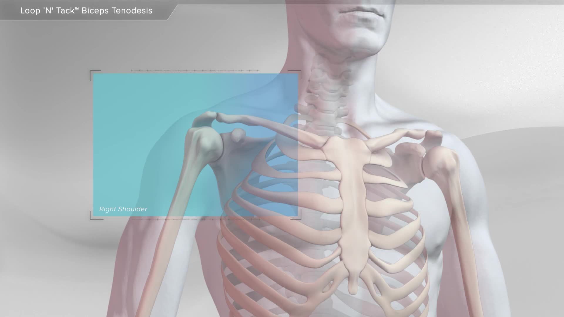 Arthrex - Loop 'N' Tack™ Biceps Tenodesis