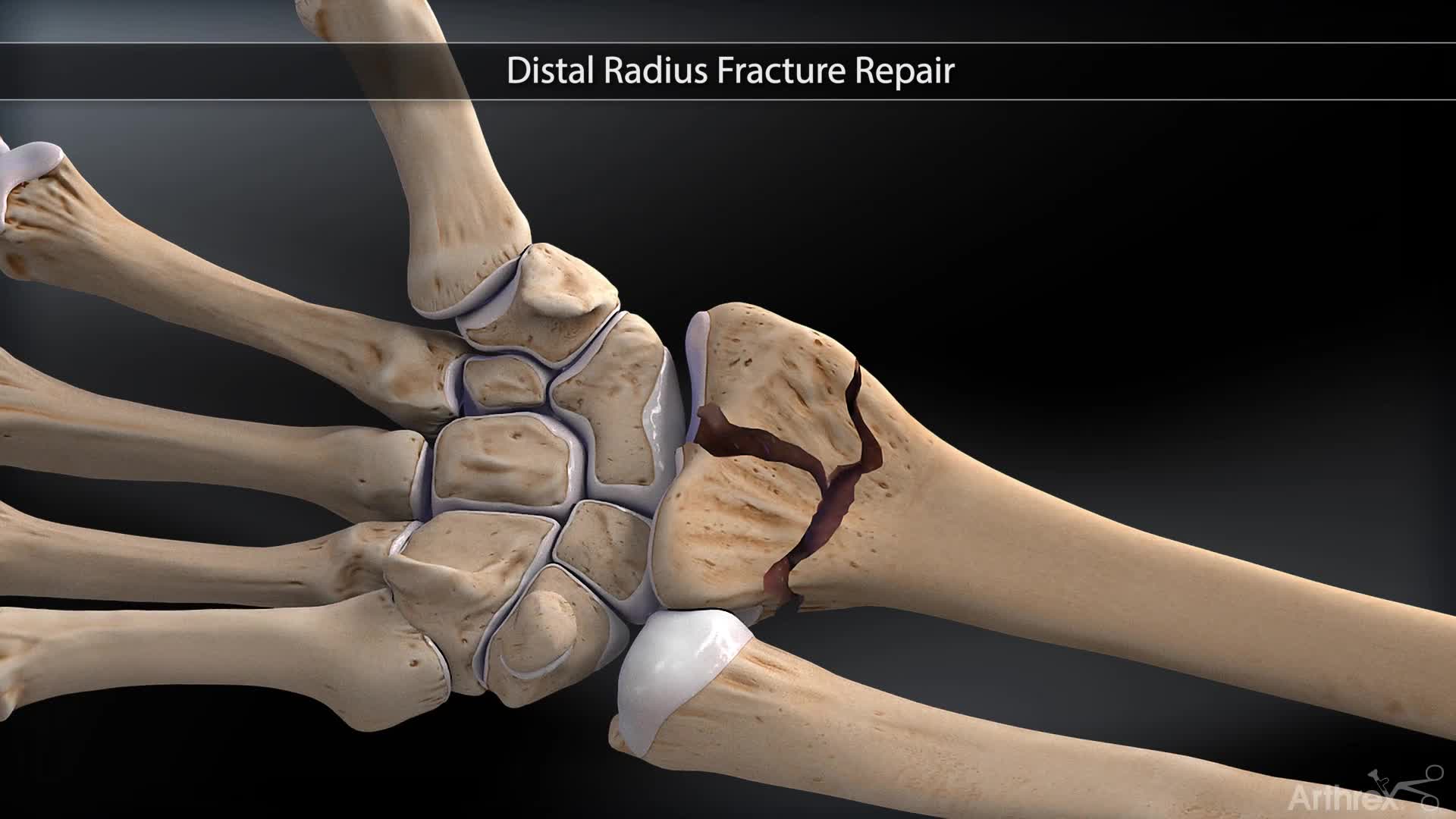 Arthrex - Distal Radius Fracture Repair