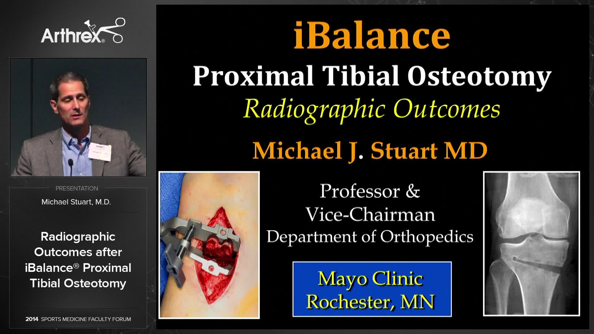 Arthrex - Radiographic Outcomes After iBalance® Proximal Tibial Osteotomy