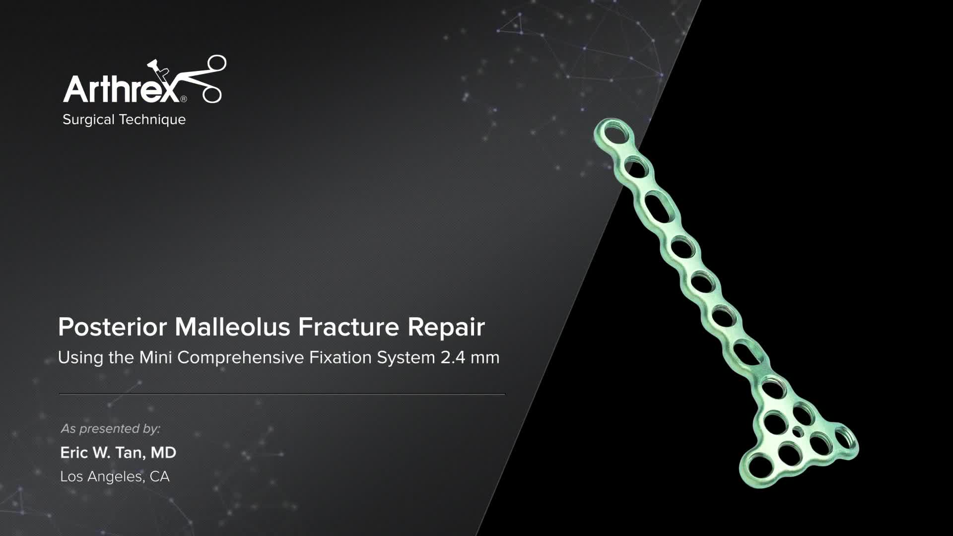 Arthrex - Posterior Malleolus Fracture Repair Using the Mini ...