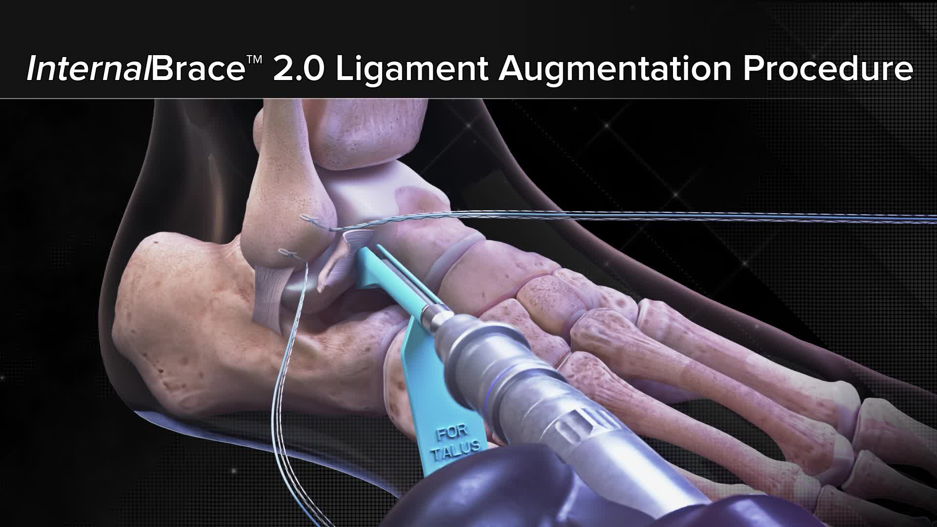 Arthrex - InternalBrace 2.0 Ligament Augmentation Procedure