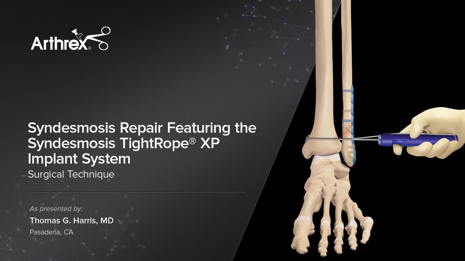 Arthrex - Syndesmosis Repair Featuring the Syndesmosis TightRope® XP ...