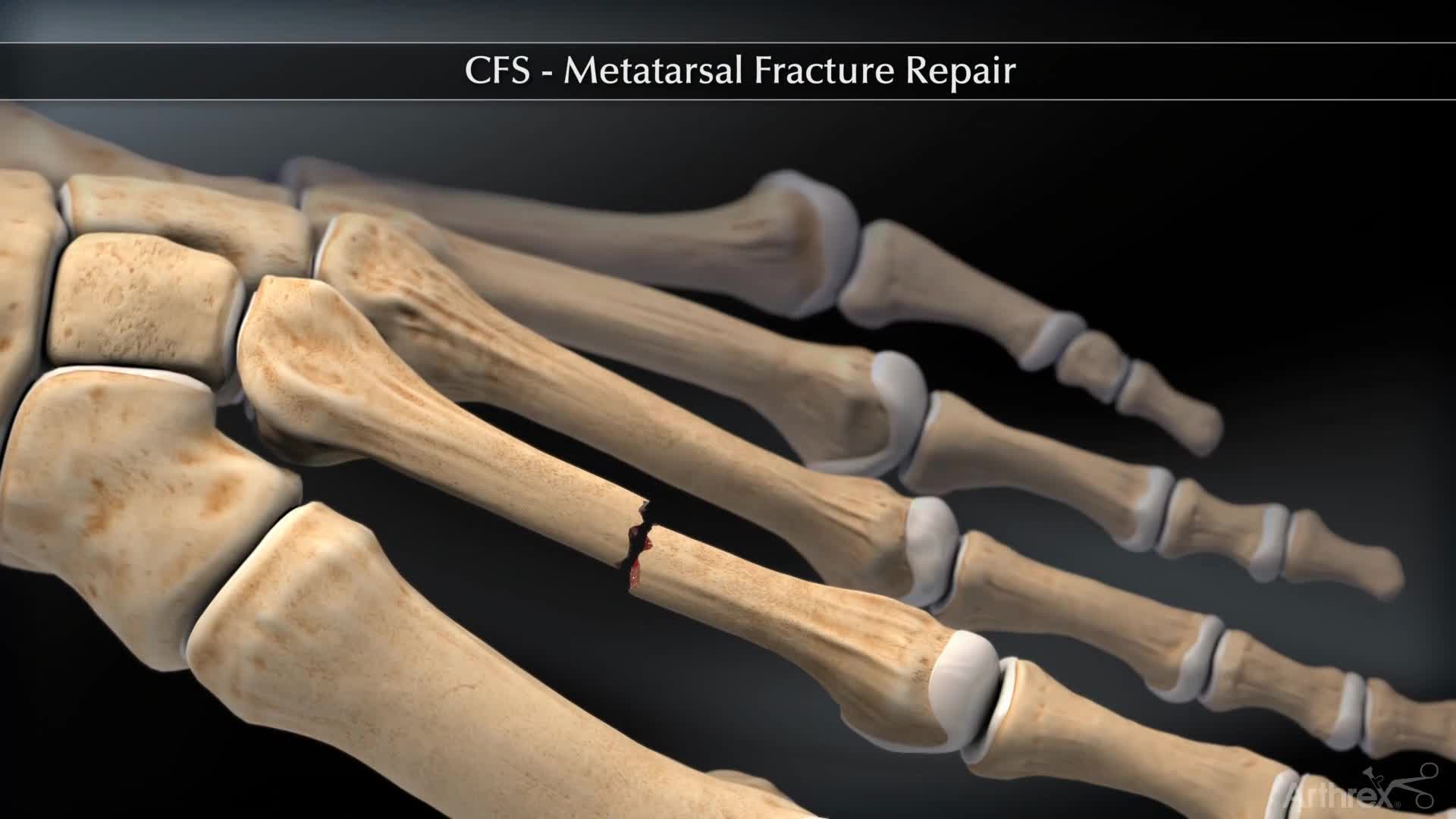 Arthrex - CFS Metatarsal Fracture Repair