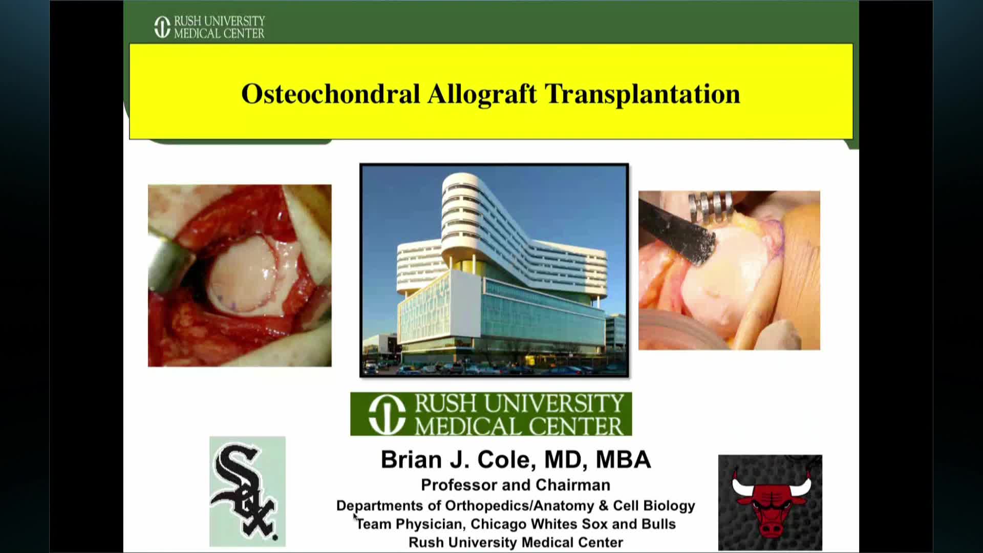 Arthrex - Osteochondral Allograft Transplantation