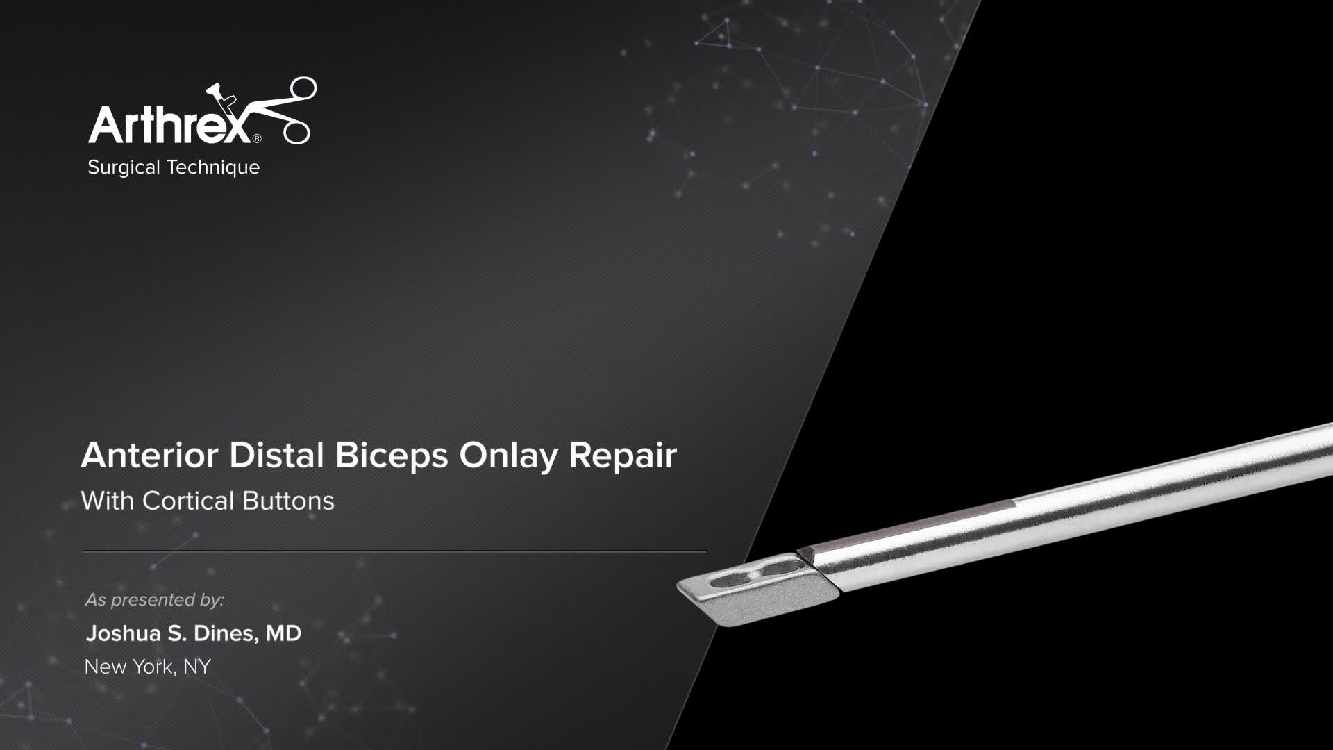Arthrex - Anterior Distal Biceps Onlay Repair With Cortical Buttons