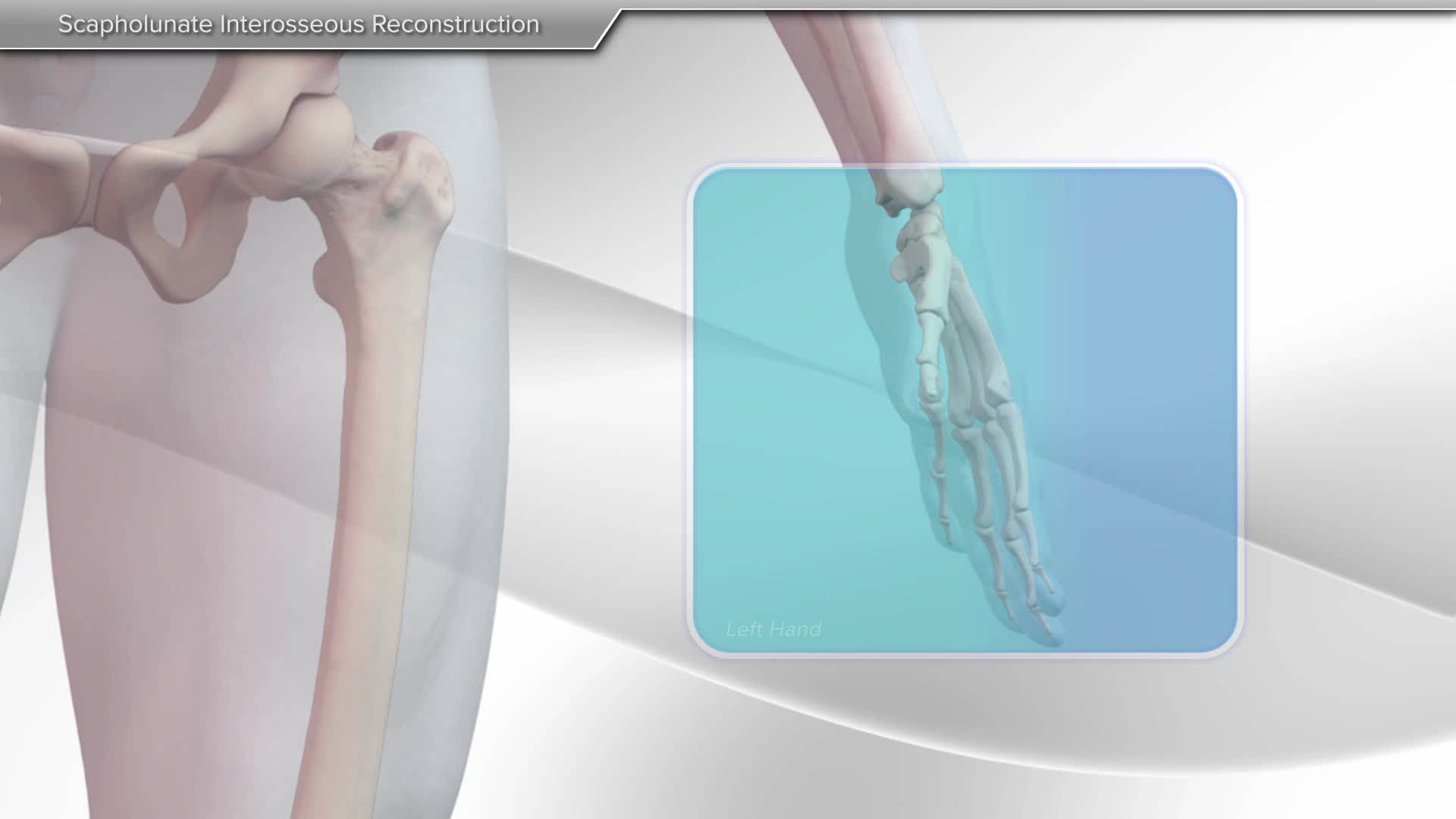 Arthrex - Scapholunate Ligament Reconstruction
