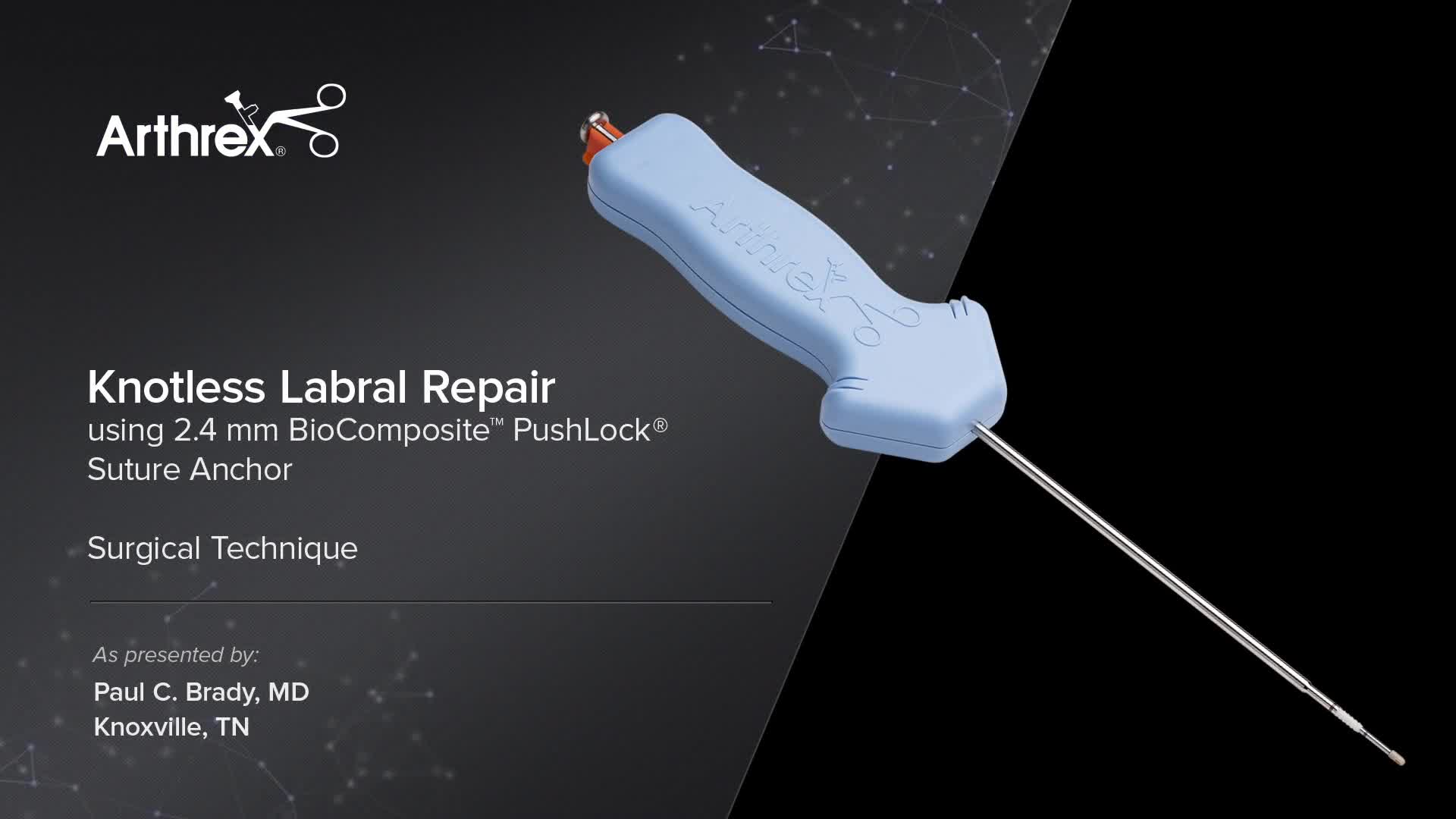 Arthrex - Knotless Labral Repair using 2.4 mm BioComposite™ PushLock ...