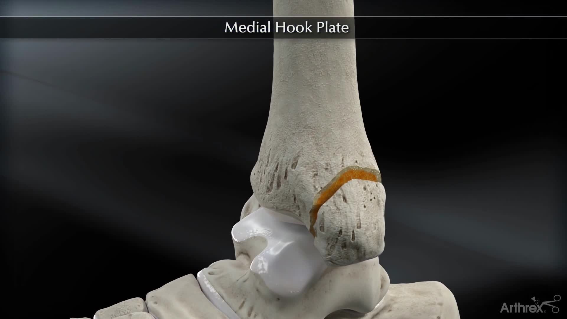 Arthrex - Medial Hook Plate