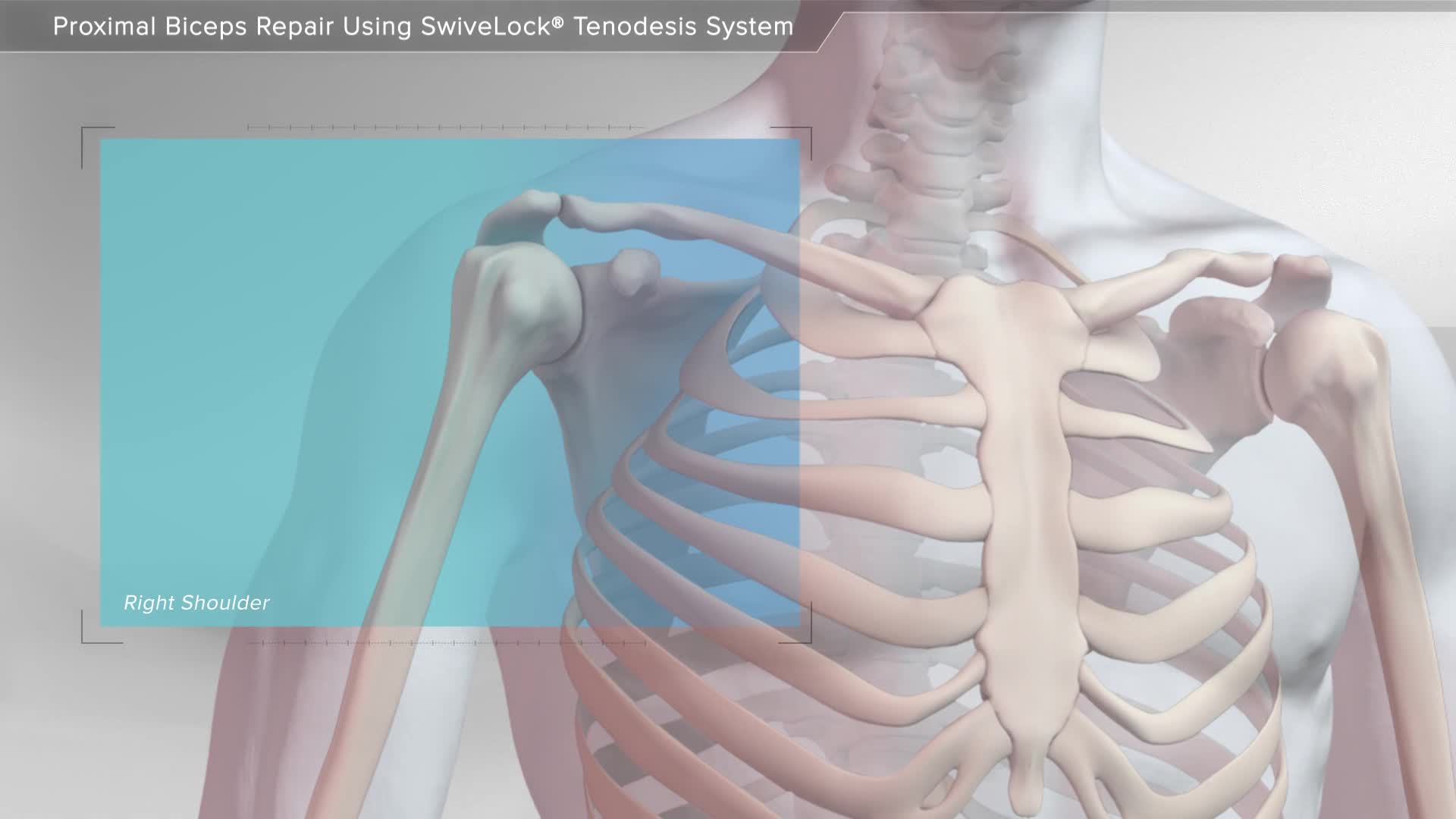 Arthrex - Proximal Biceps Repair Using SwiveLock® Tenodesis System