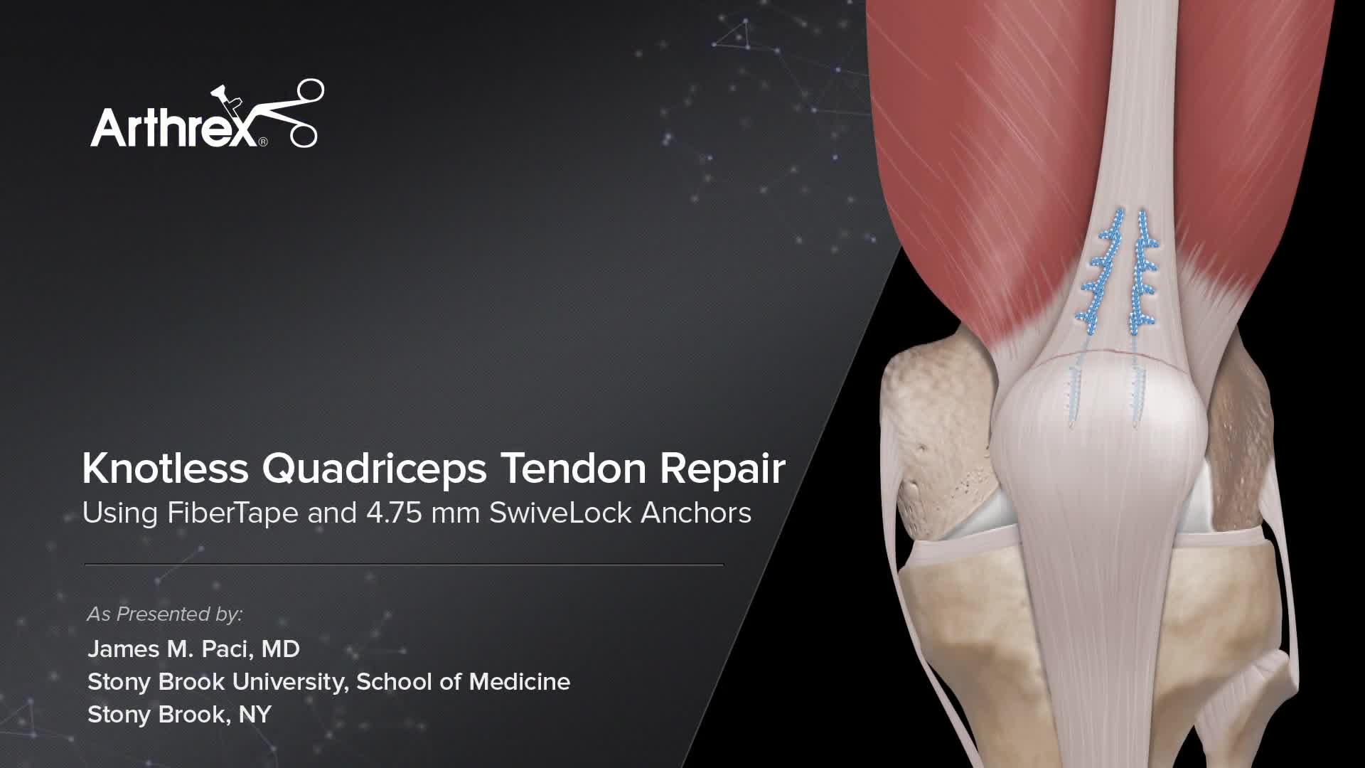 Arthrex - Knotless Quadriceps Tendon Repair Using FiberTape® and 4.75 ...