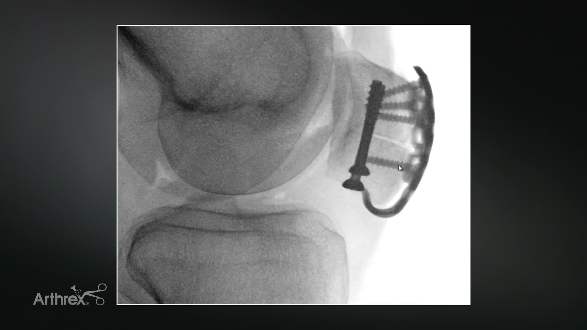 Arthrex - Patella Fracture Fixation Using Cannulated Screws With ...