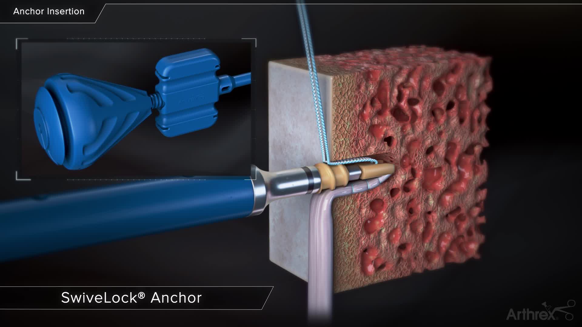 Arthrex - Anchor Insertion