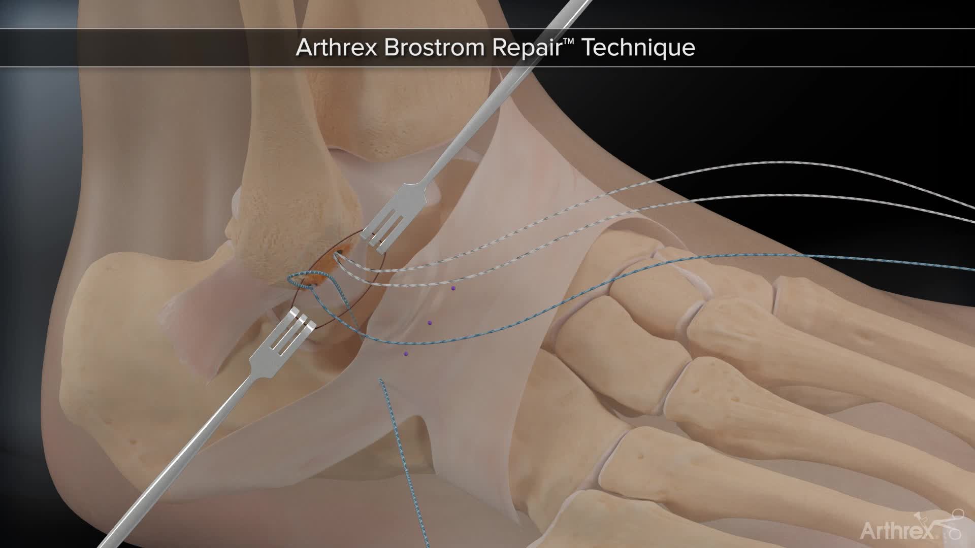 Arthrex - Arthrex Brostrom Repair™
