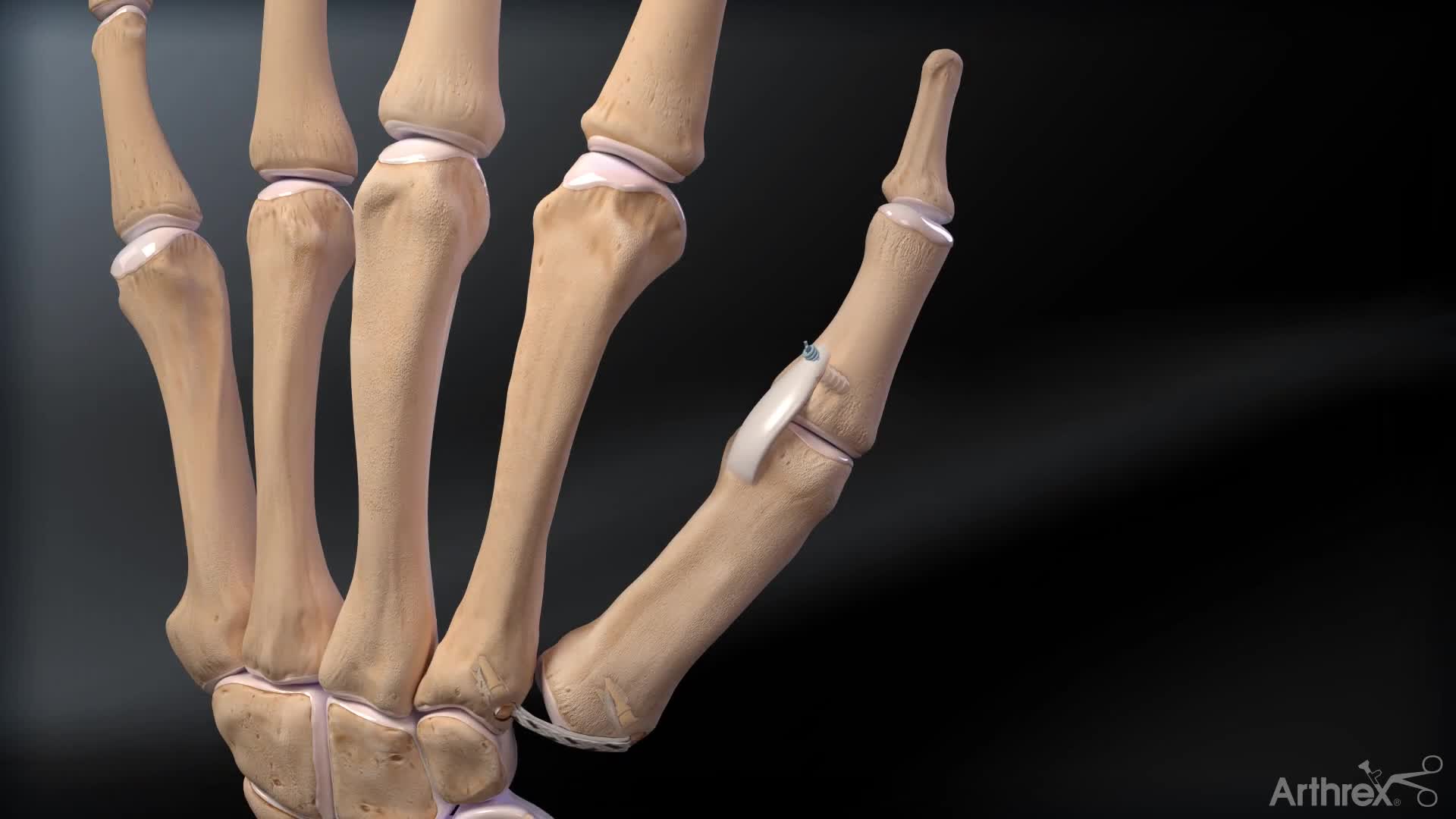 Arthrex - Distal Extremities Anchors - Hand & Wrist