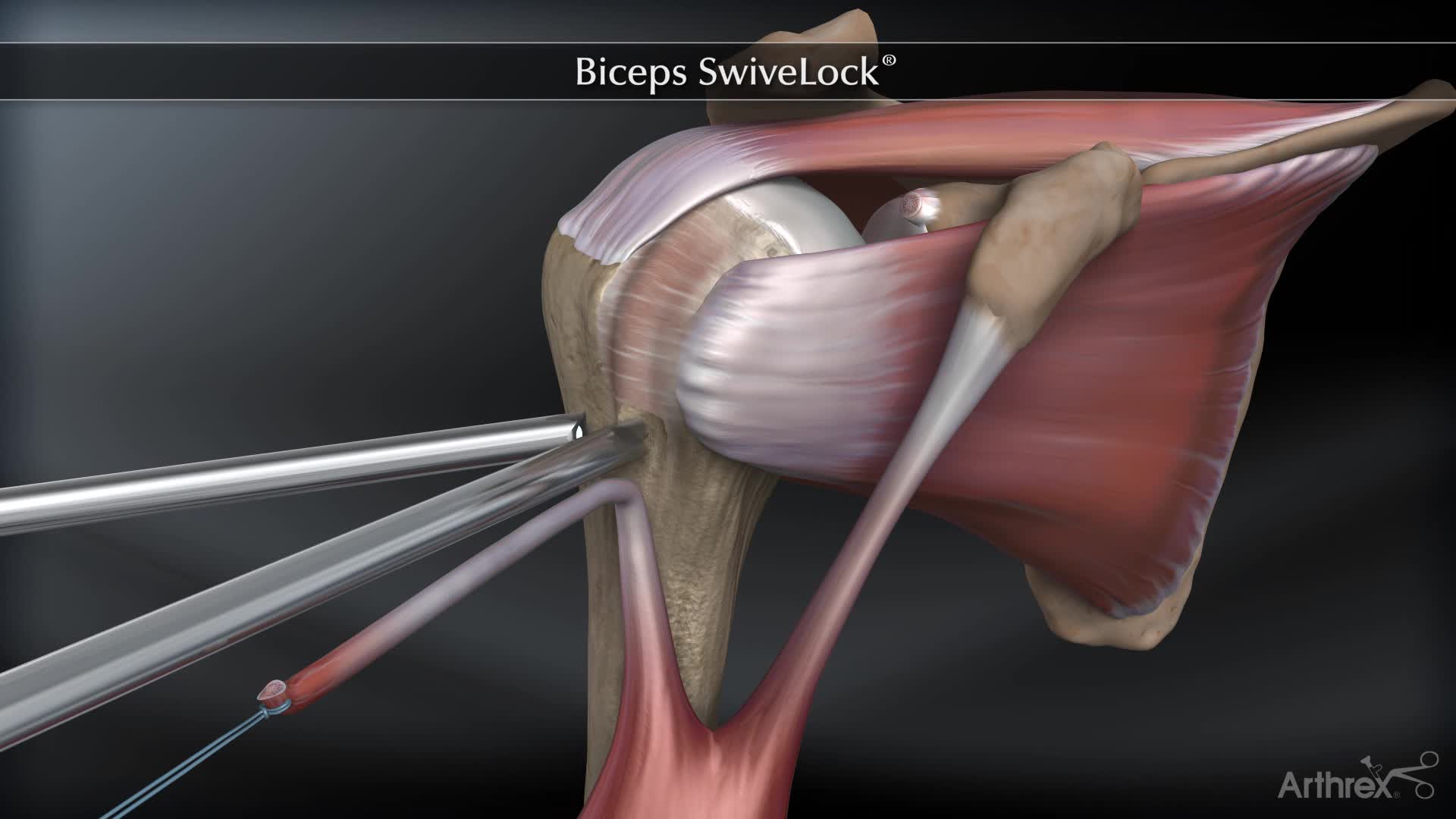 Arthrex - Biceps SwiveLock®