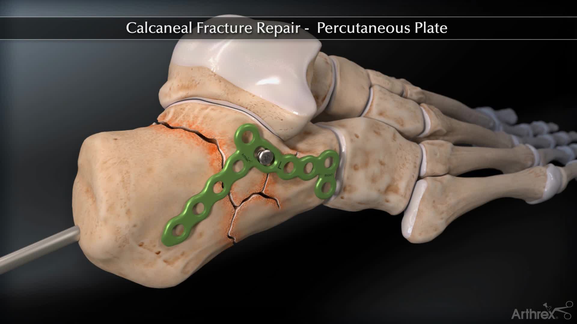 Arthrex - Calcaneal Fracture Percutaneous Plate