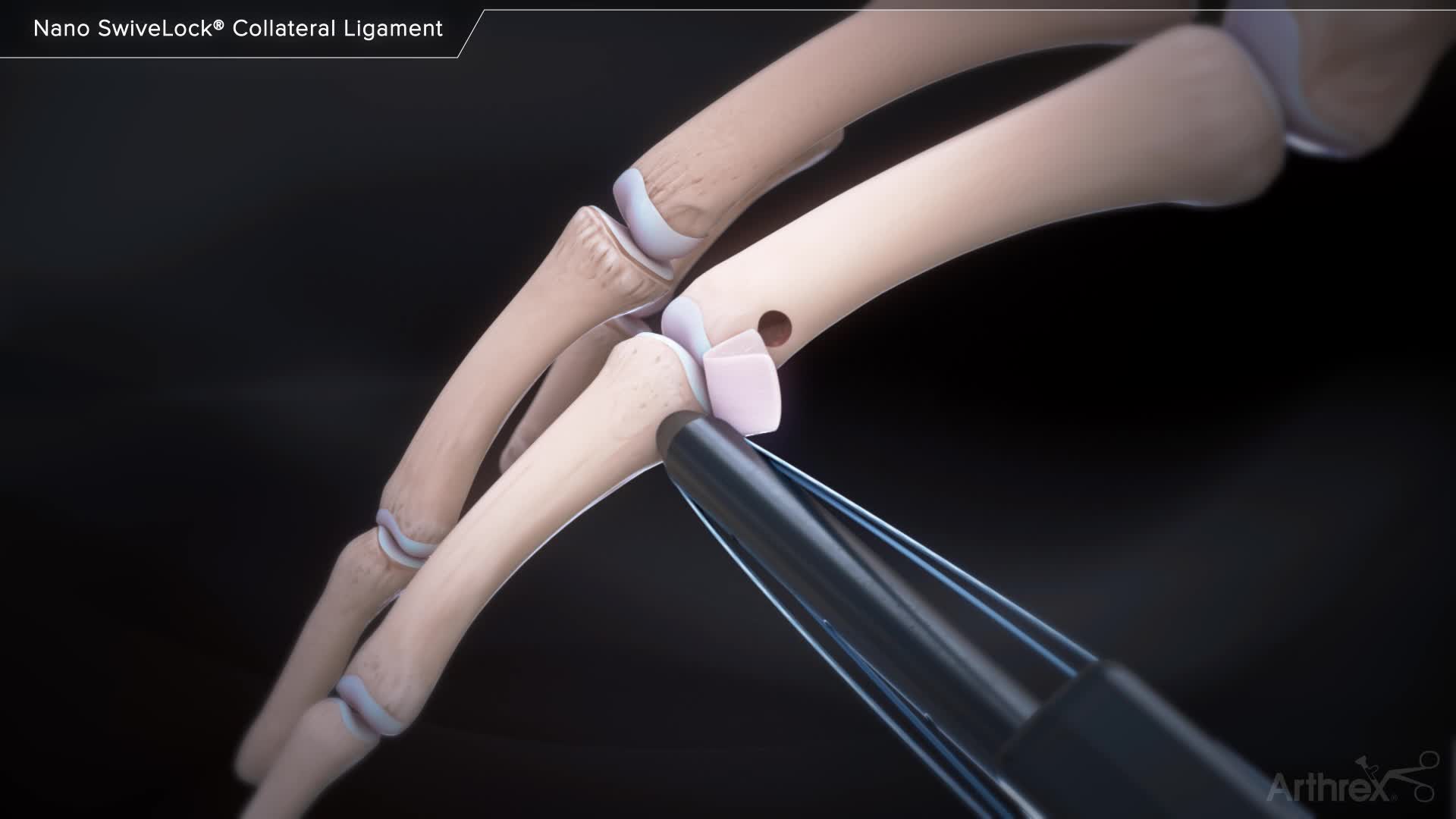 Arthrex - Nano SwiveLock® Collateral Ligament