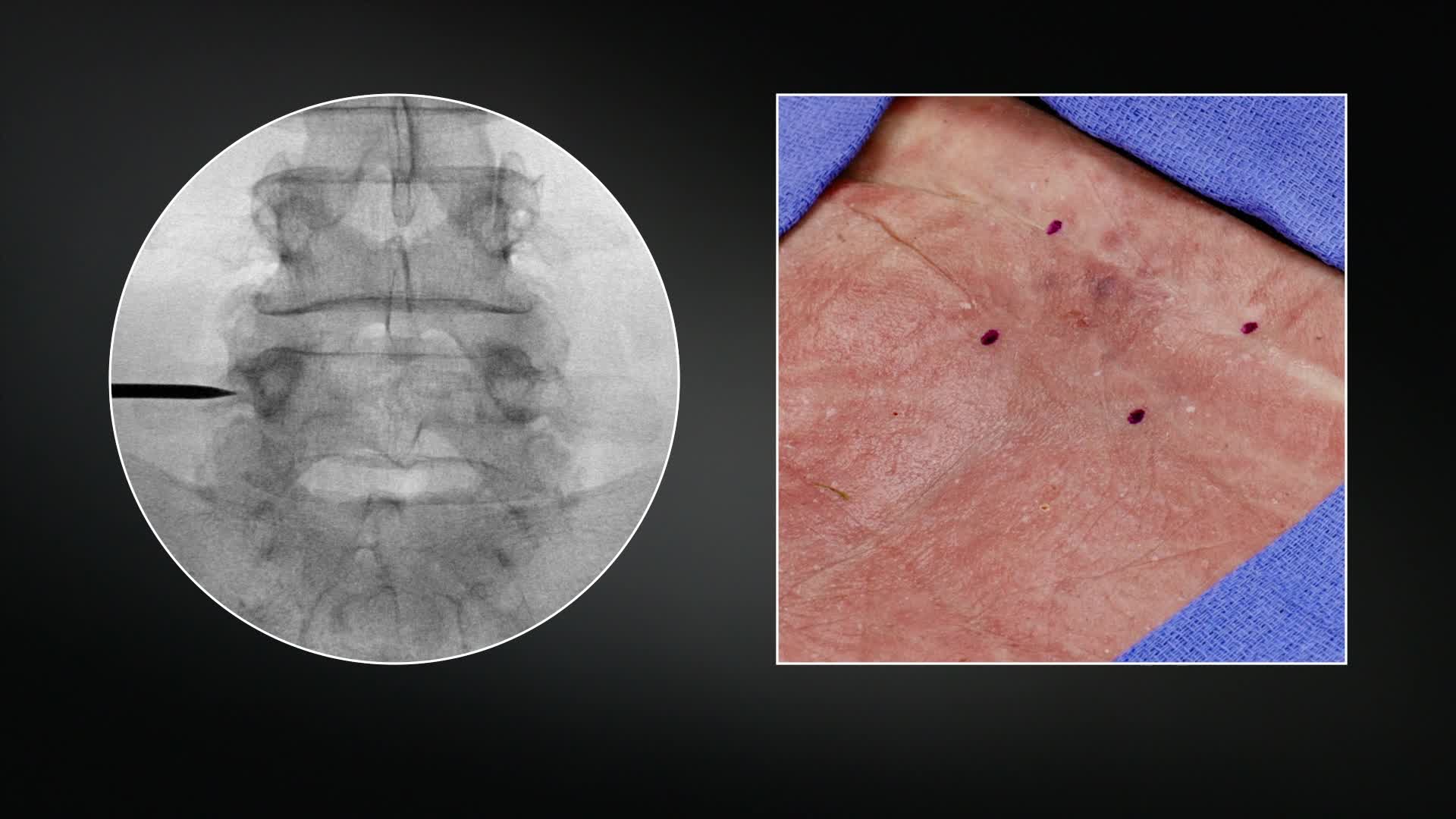 Arthrex - Medial Branch Nerve Transection Procedure