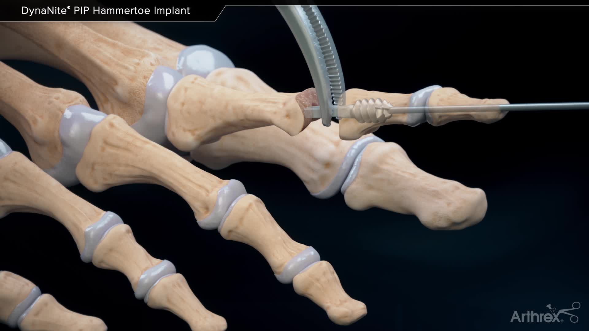 Arthrex - DynaNite® PIP Hammertoe Implant