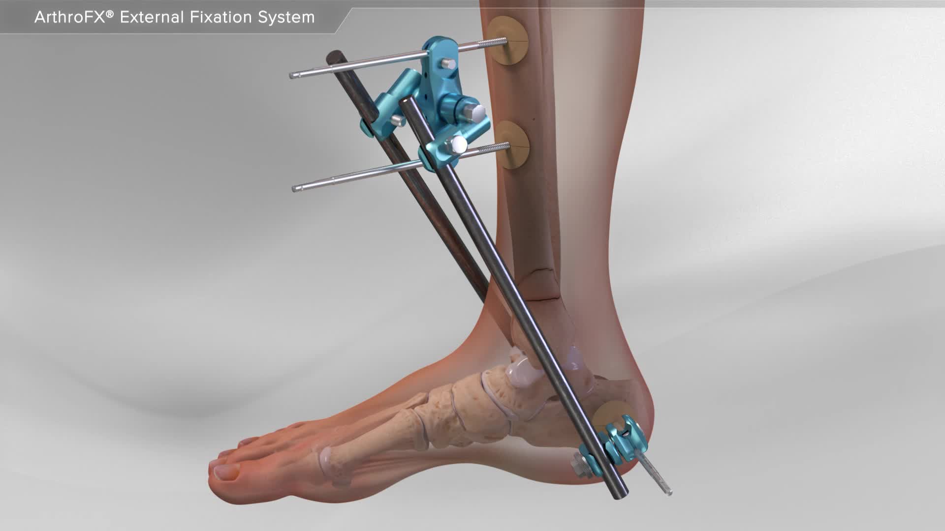 Arthrex - ArthroFX® External Fixation System