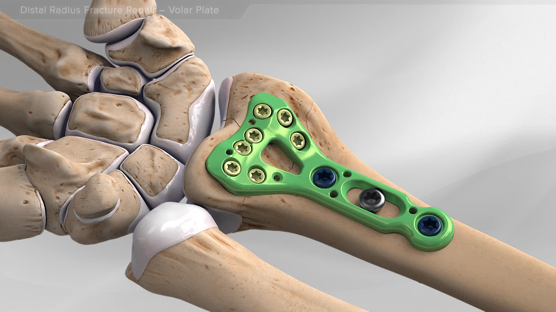 Arthrex - Distal Radius Fracture Repair - Volar Plate