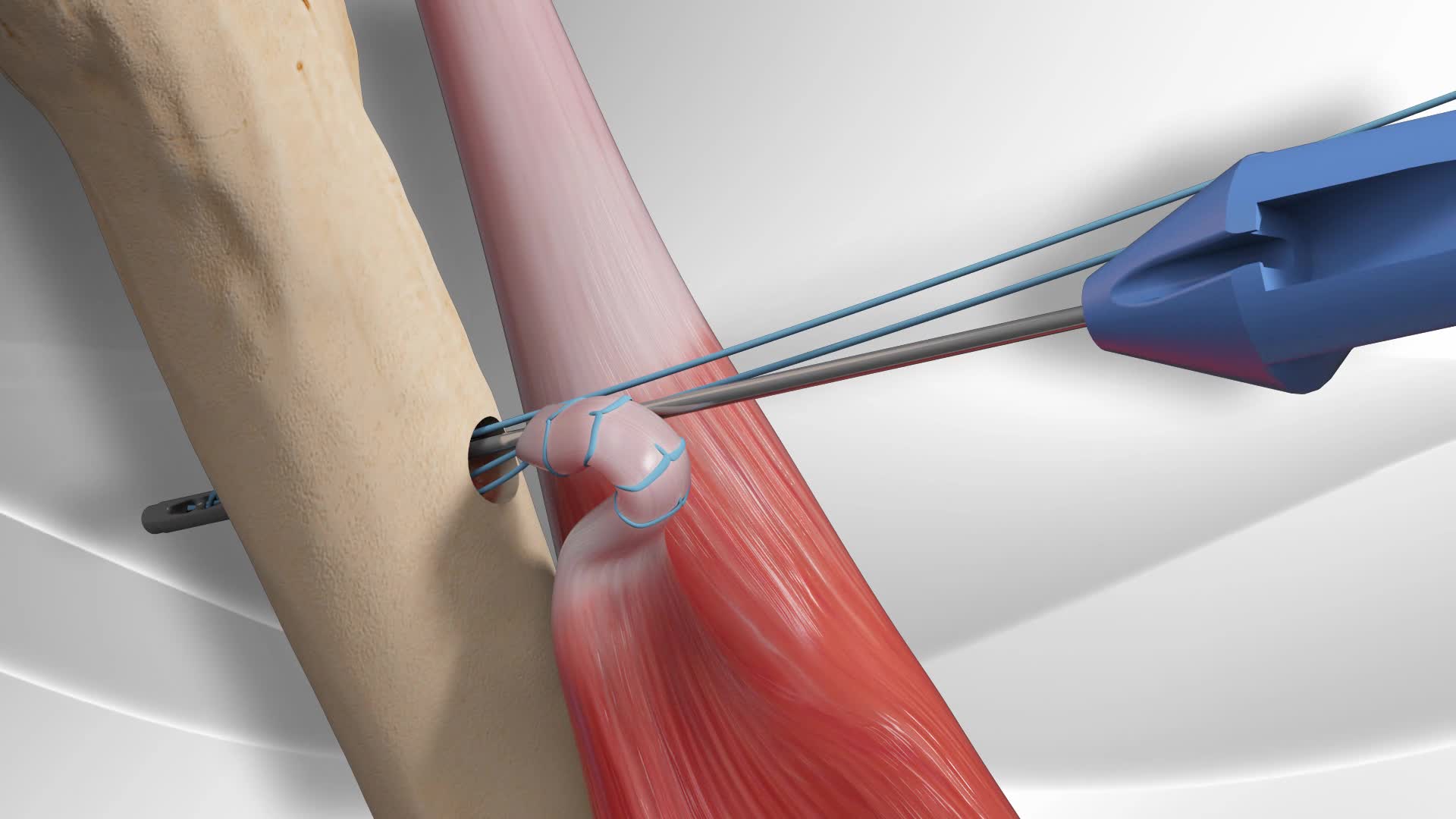 Arthrex - Biceps Tenodesis with BicepsButton™ Kit