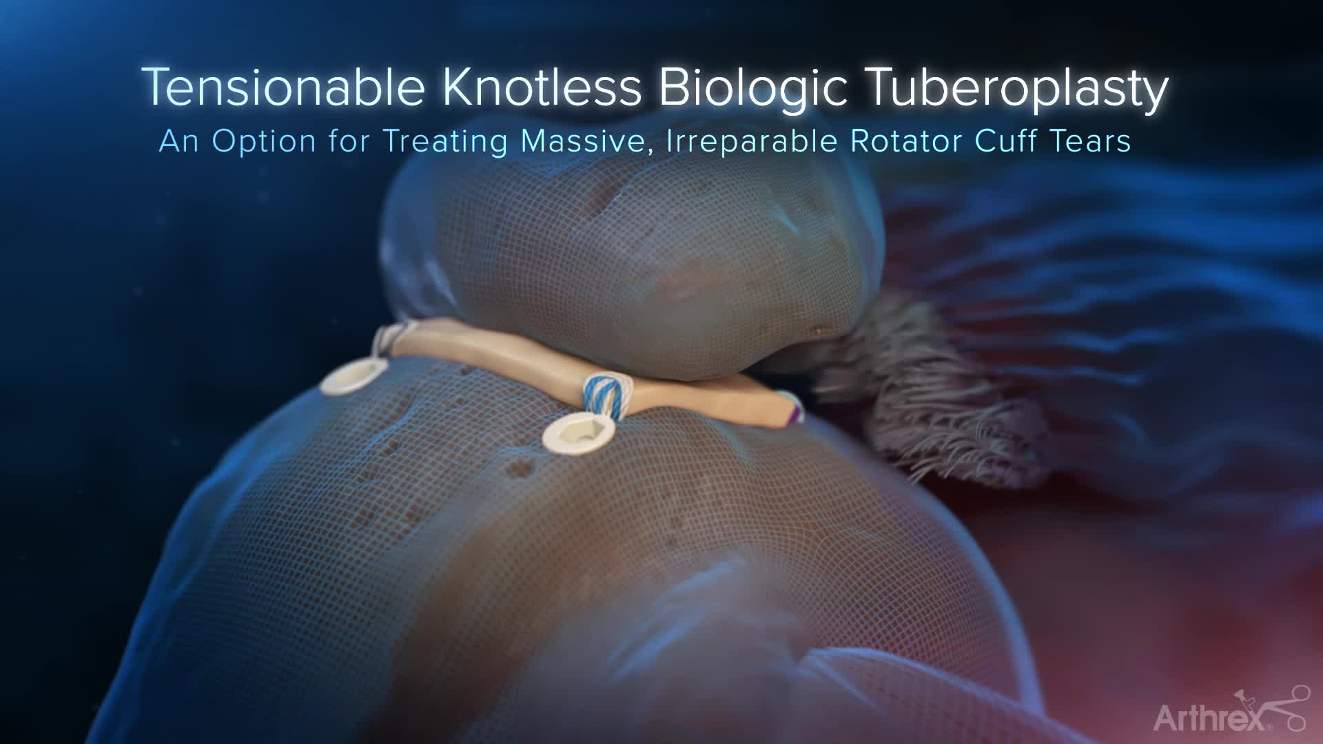 Arthrex - Tensionable Knotless Biologic Tuberoplasty for Treating ...