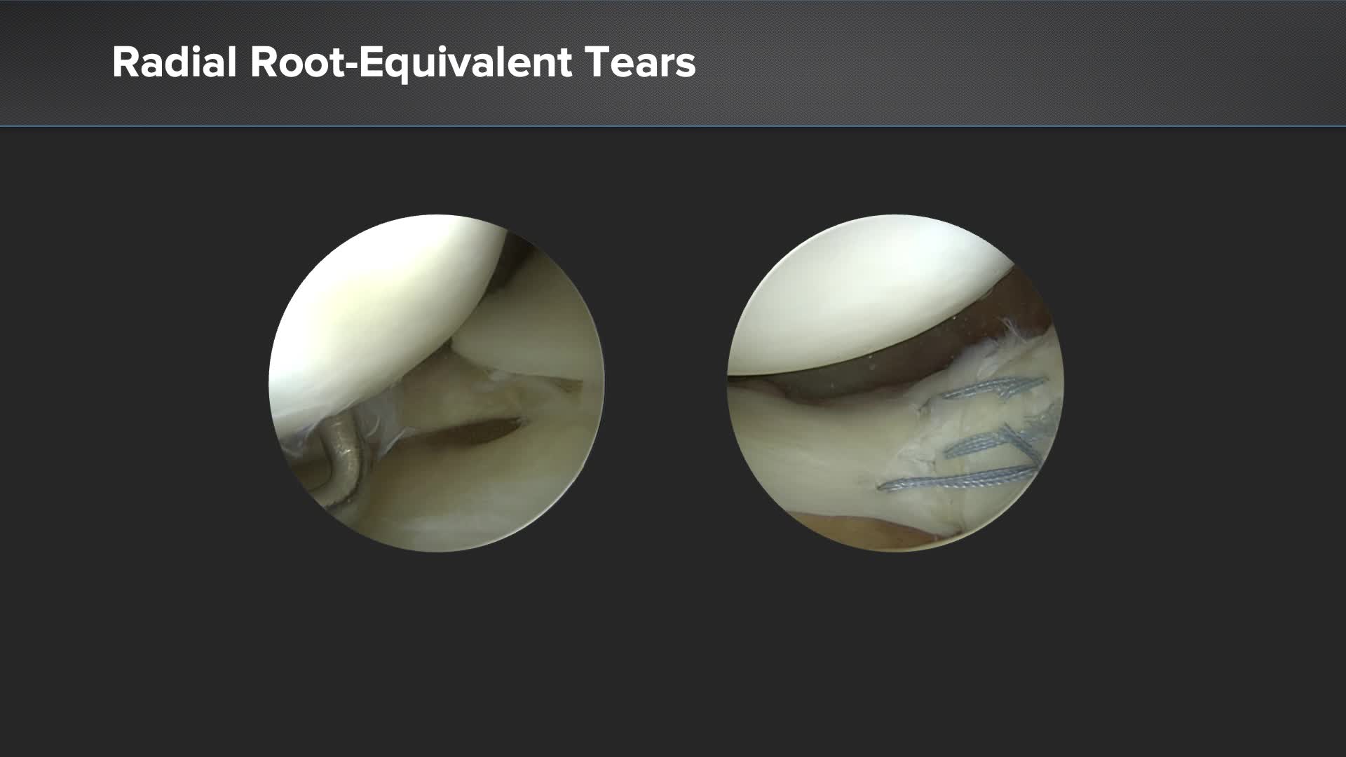 Arthrex - My Approach to Ramp Lesions, Radial Tears, and Meniscal Root ...