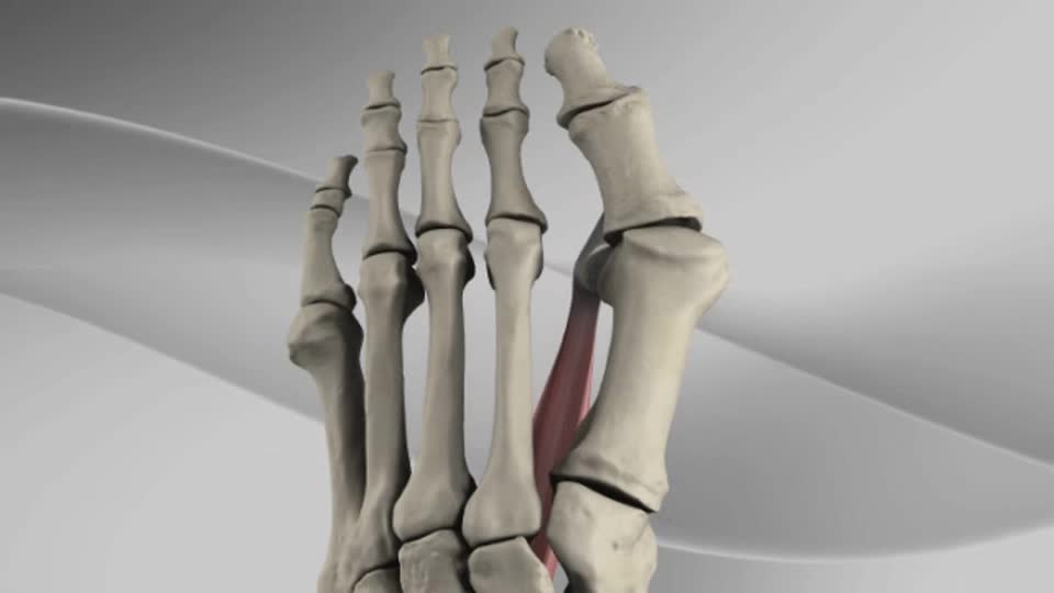 Arthrex - First Metatarsal Phalangeal Joint Fusion with Lapidus Plate ...