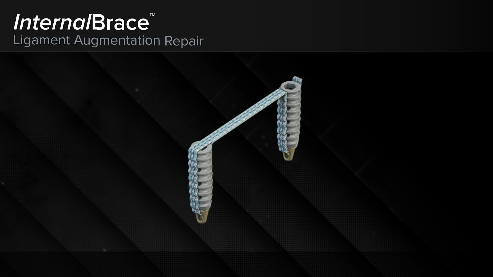 Arthrex - InternalBrace™ Ligament Augmentation Repair—“The Body's ...
