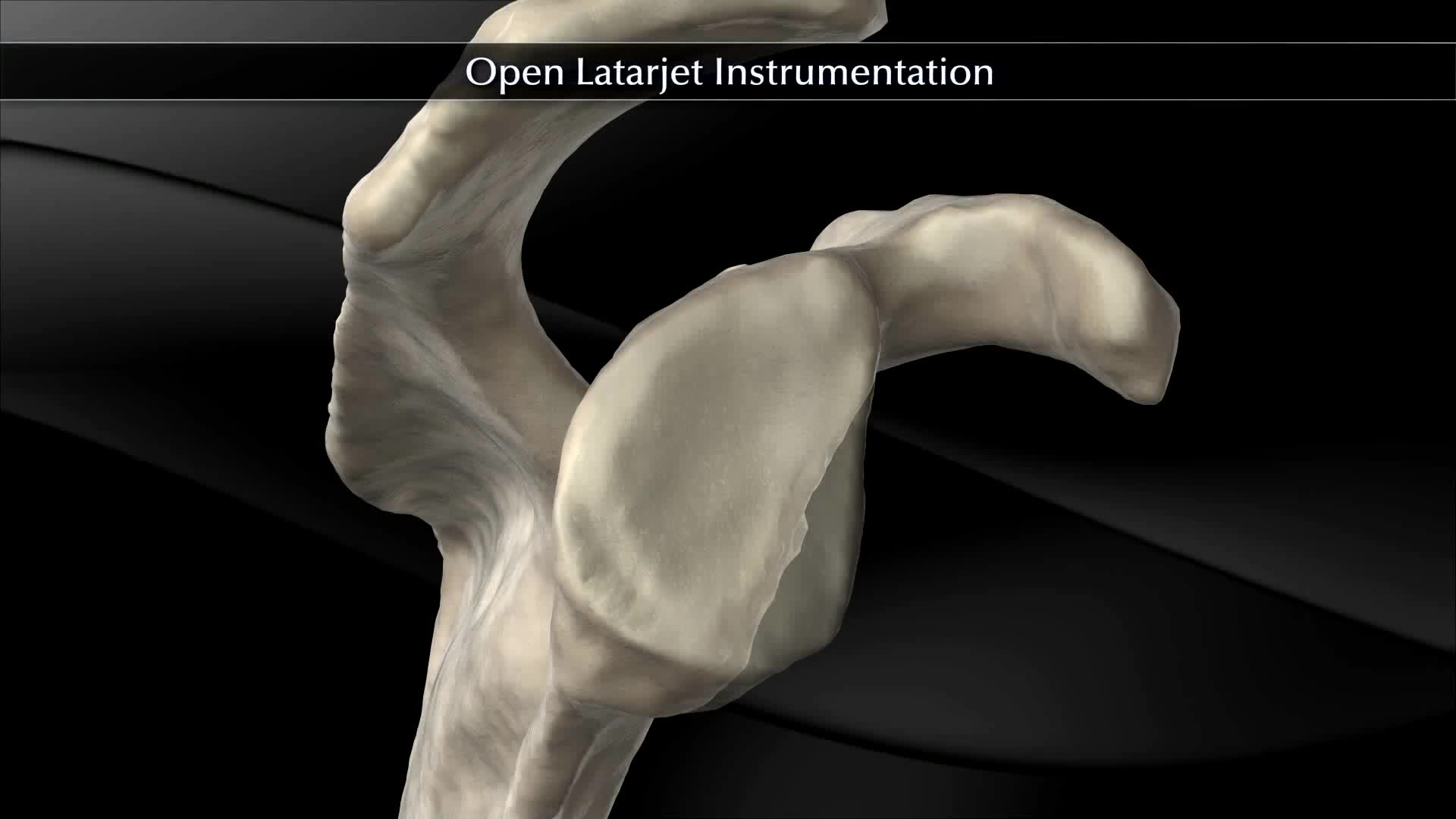 Arthrex - Open Latarjet Instrumentation