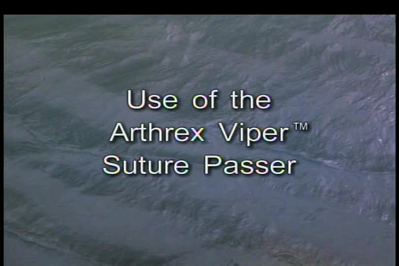 Arthrex - The Use of the Arthrex Viper™ Suture Passer