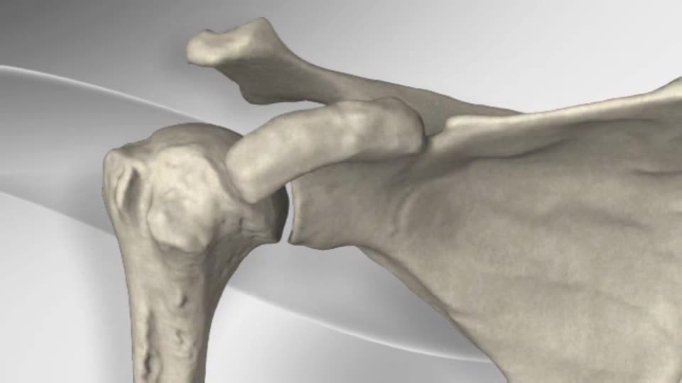 Arthrex - Total Shoulder Replacement with Univers™ II System Arthrex - Total Shoulder Replacement with Univers™ II System