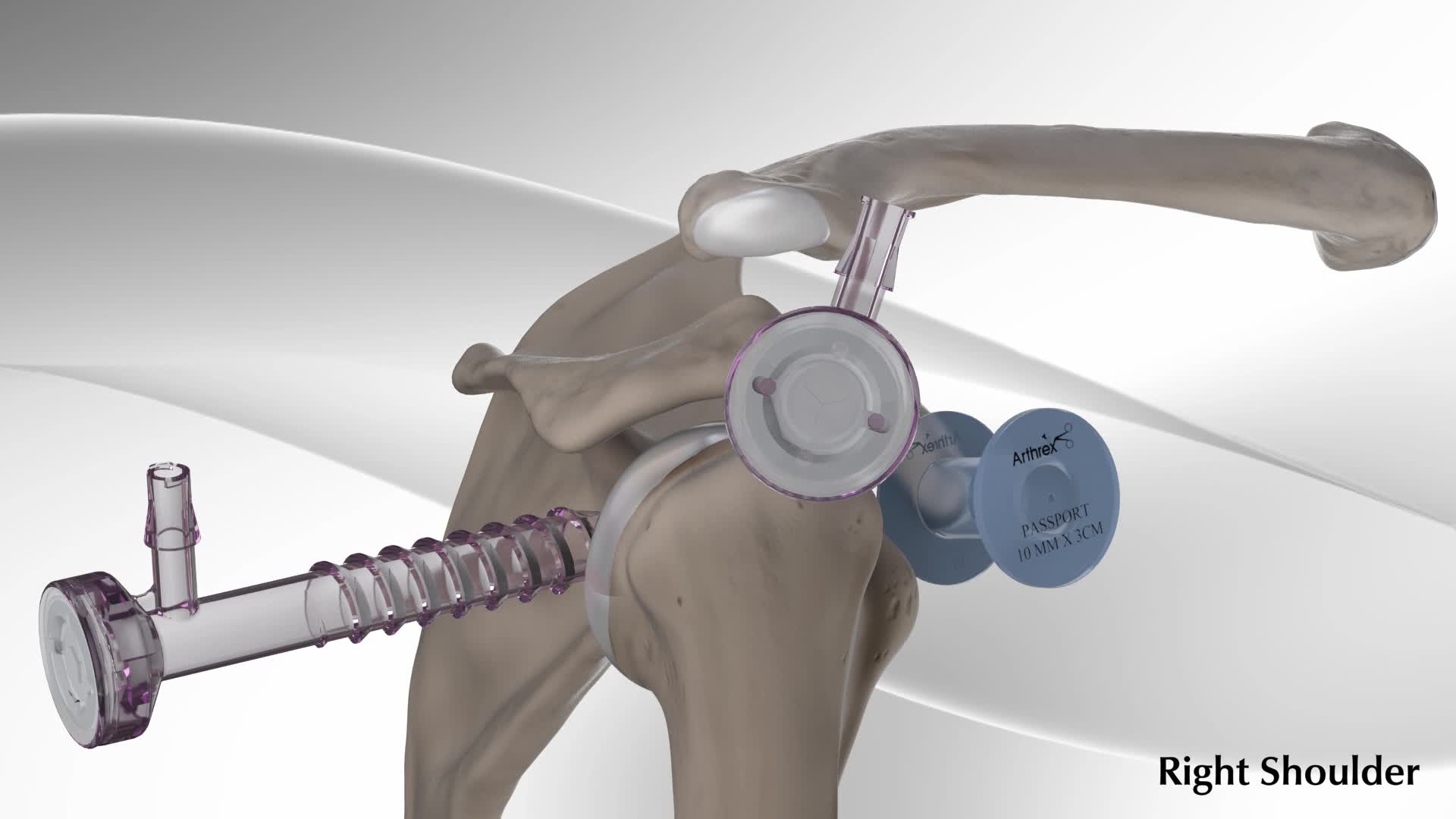 Arthrex - AC Joint Repair with Dog Bone™ Button