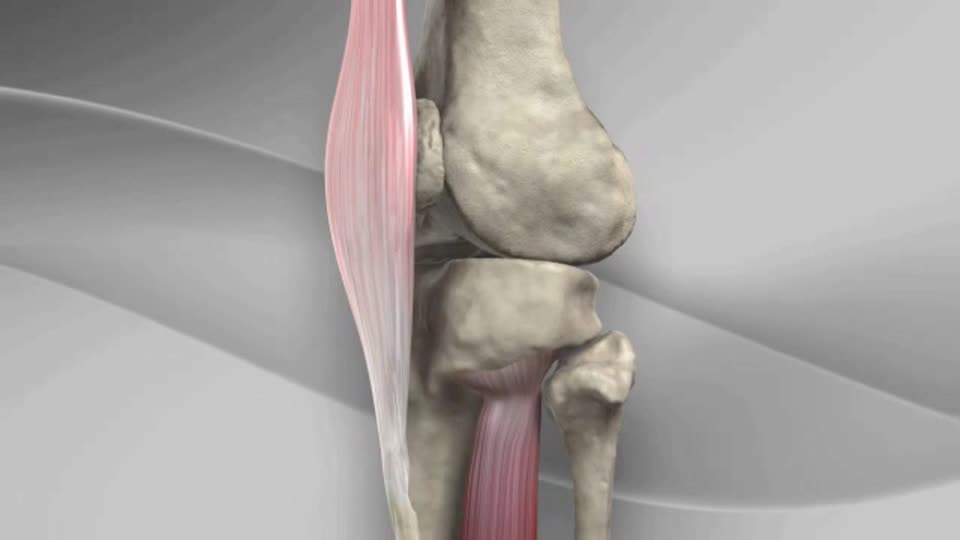 Arthrex - Osteotomie der Tuberositas Tibiae mit dem T3® AMZ System