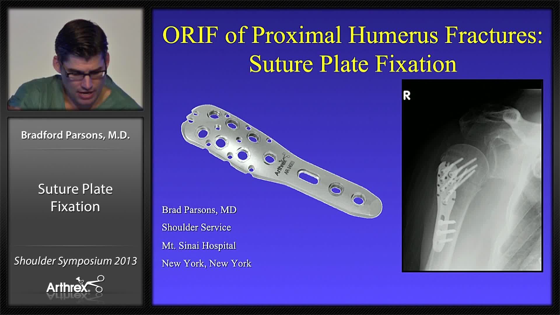 Arthrex - Proximal Humeral Fractures: Humeral Locked Plating ...