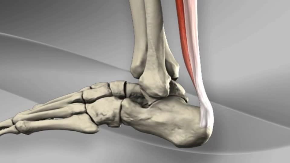 Arthrex - Achilles SutureBridge™