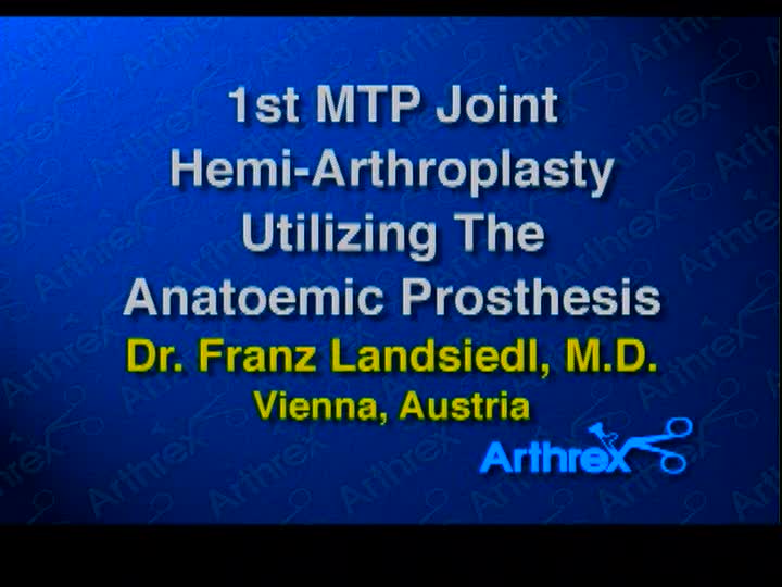 Arthrex - 1st MTP Joint Hemi-Arthroplasty Utilizing The AnaToemic ...