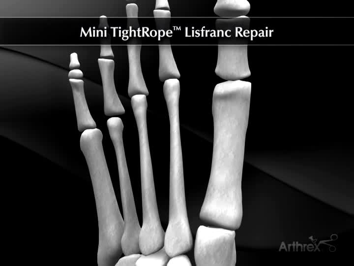 Arthrex - Mini TightRope® Lisfranc Repair