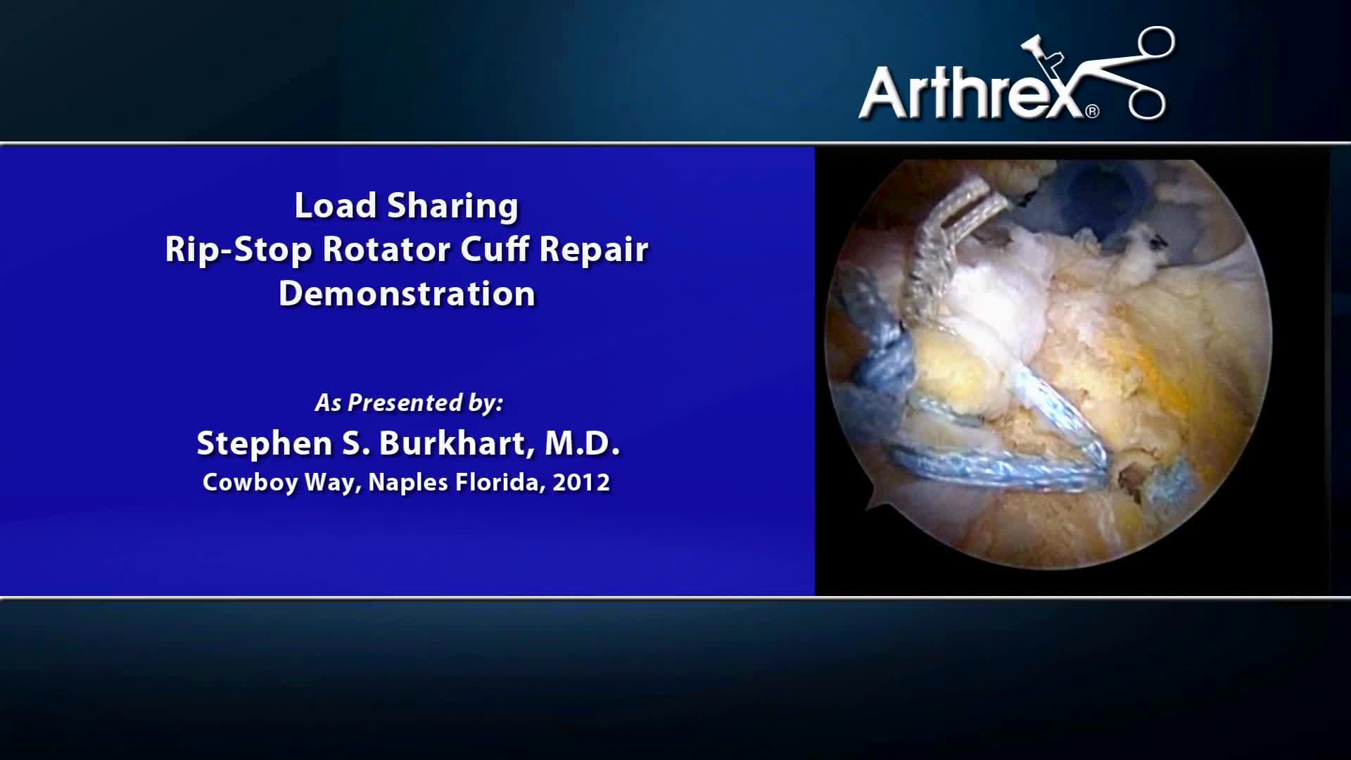 Arthrex - Load Sharing Rip-Stop Rotator Cuff Repair Demonstration